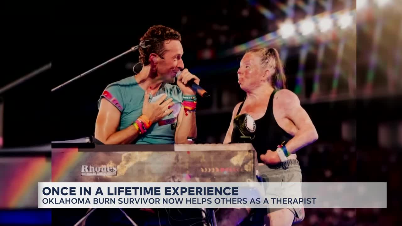 Oklahoma burn survivor turned therapist shares her inspiring journey