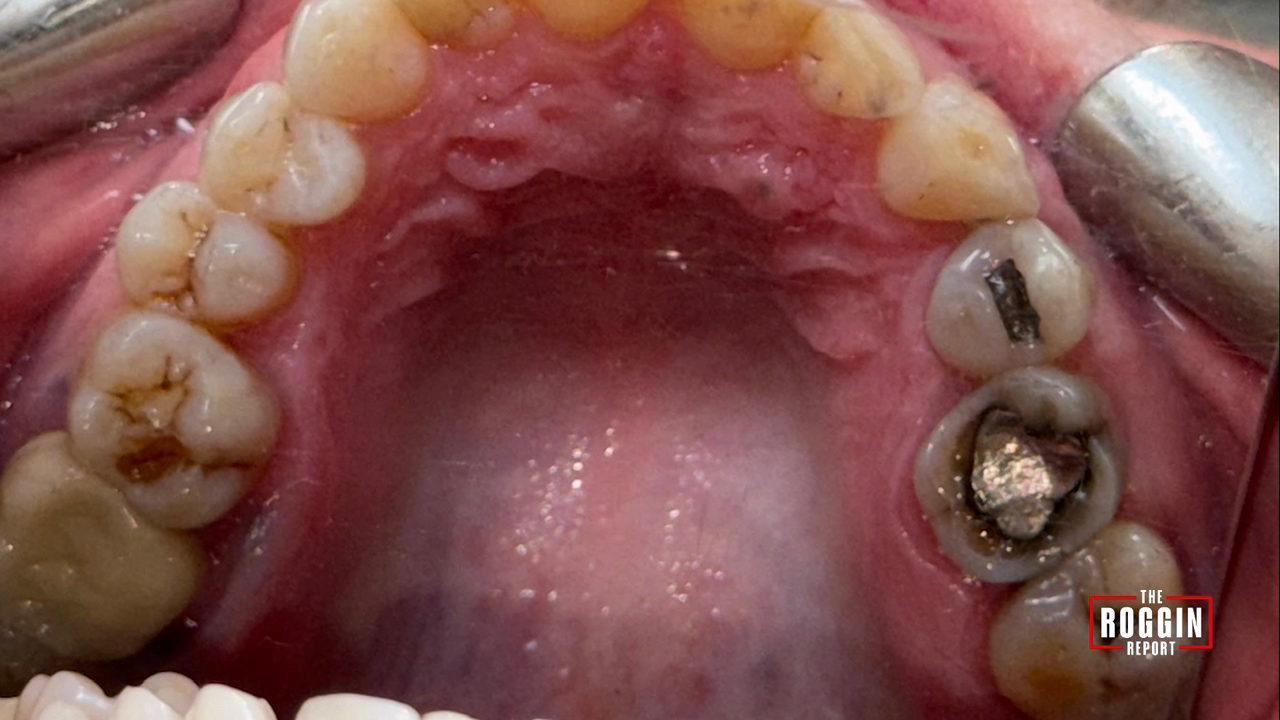 Mercury Fillings: Why Your Old Dental Work Could Be Causing Damage