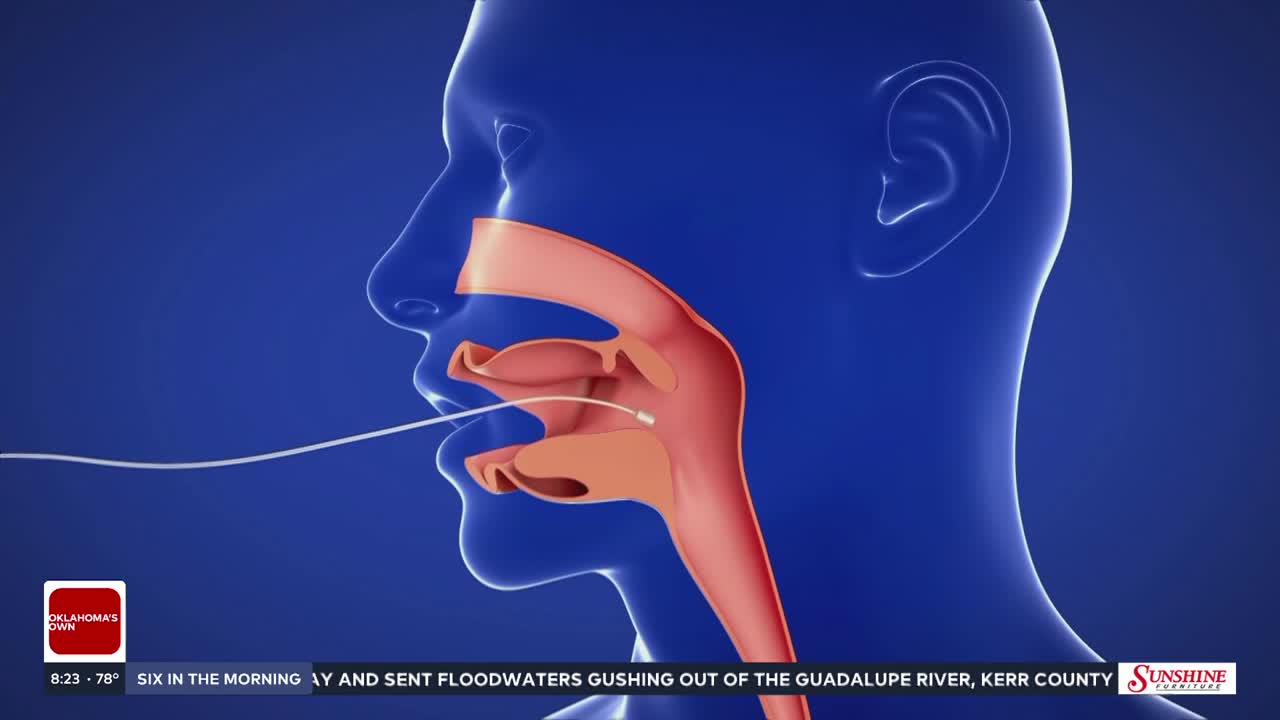 New test helps detect esophageal cancer earlier